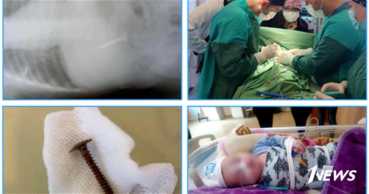 В Сумгайыте врачи извлекли саморез из ЖКТ 4-месячного ребенка - ФОТО | 1news.az | Новости